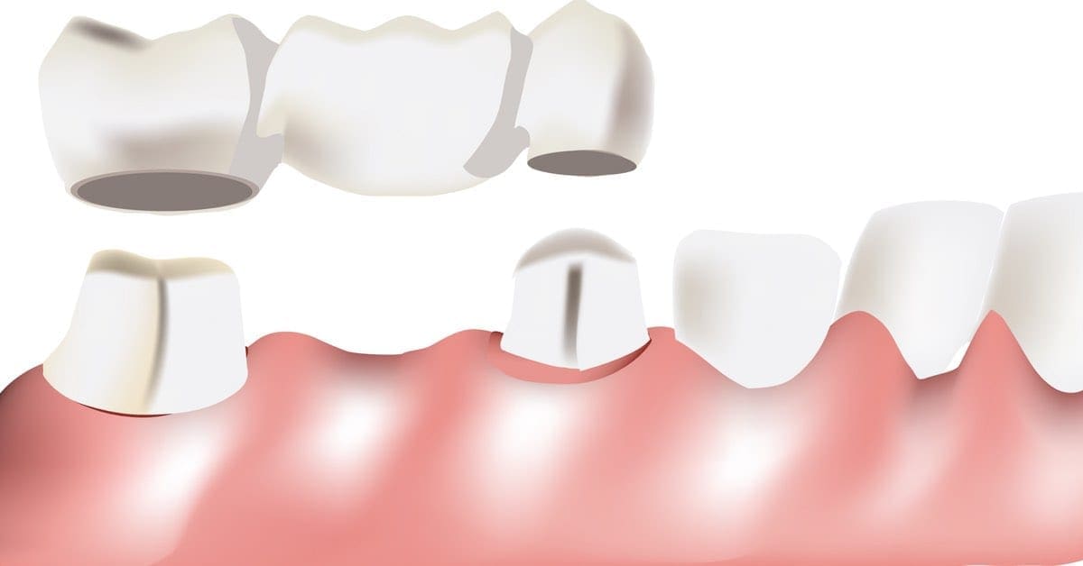 Dental Bridges To Replace Missing Teeth | Suburban Essex Dental Dental Bridges To Replace Missing Teeth | Suburban Essex Dental