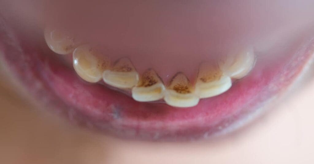 Tooth Erosion: Signs, Severity, Treatment & Prevention